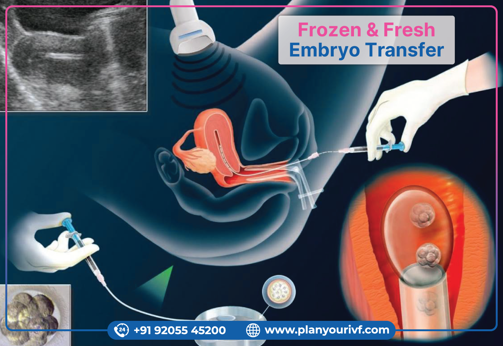 Fresh Embryo vs Frozen Embryo Transfer in IVF - Planyourivf