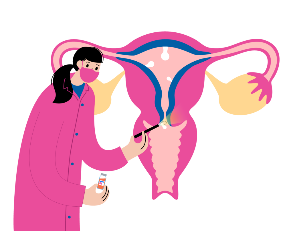 Hysteroscopy - Planyourivf