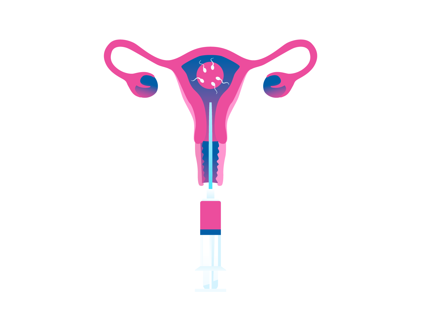 Intrauterine insemination (IUI) - Planyourivf